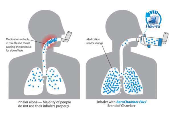 Anti-Static Valved Holding Chamber - AeroChamber Plus* Flow-Vu* Chamber